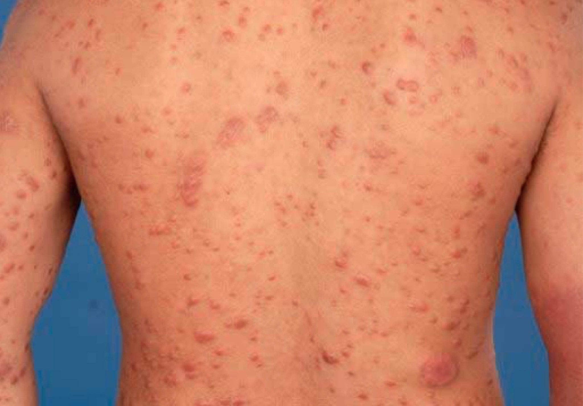 La lepra o enfermedad de Hansen