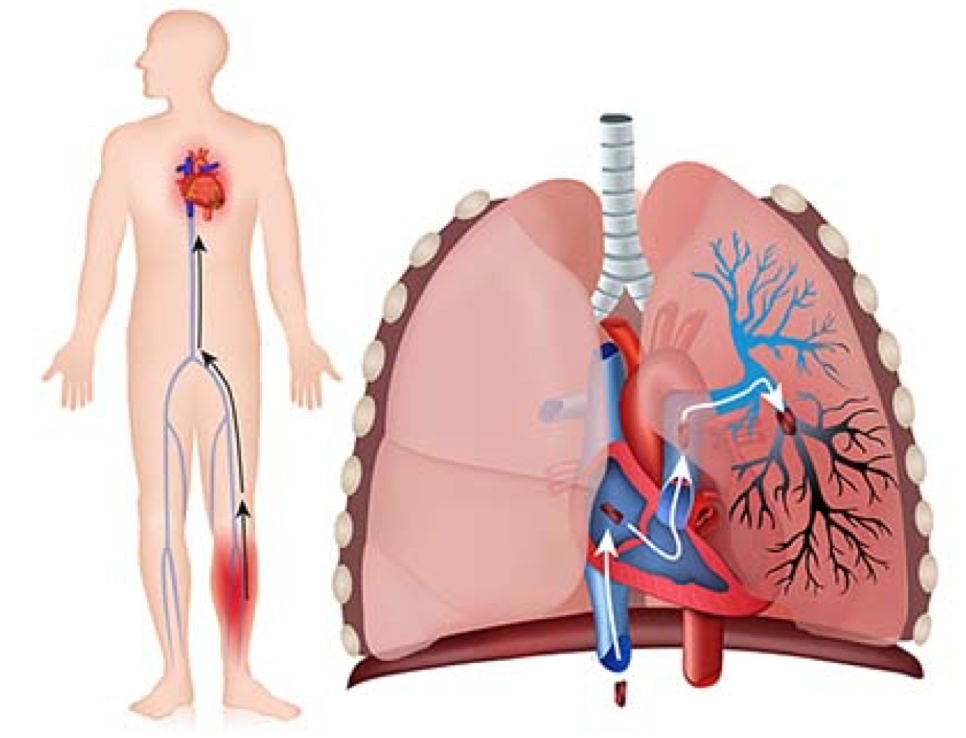 ¿Qué es la embolia pulmonar? ¿Qué es la embolia pulmonar?